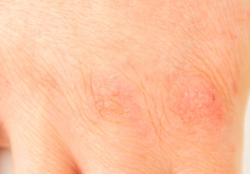 Mansonelliasis: Eine Tropenkrankheit verstehen